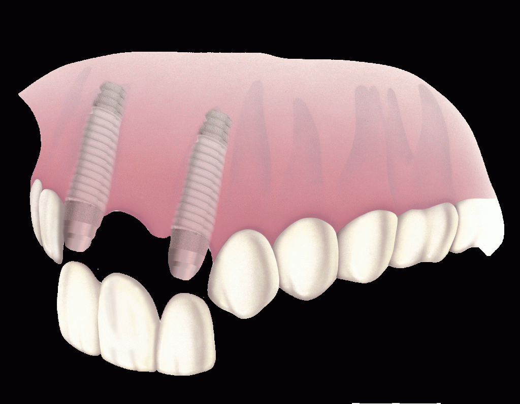 Say Goodbye to Dentures – Embrace All-On-Four Dental Implants – Kayak ...